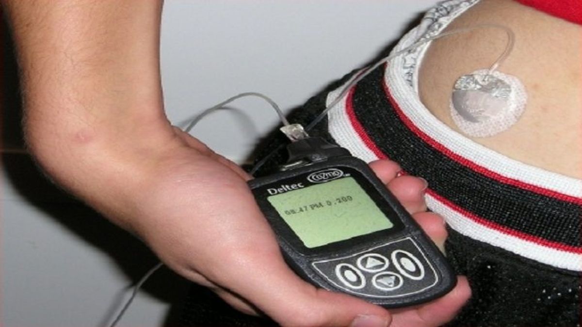Bomba de insulina será gratis para niños con diabetes tipo 1